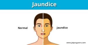 Best Jaundice Treatment in Jaipur - Dr. Shankar Dhaka