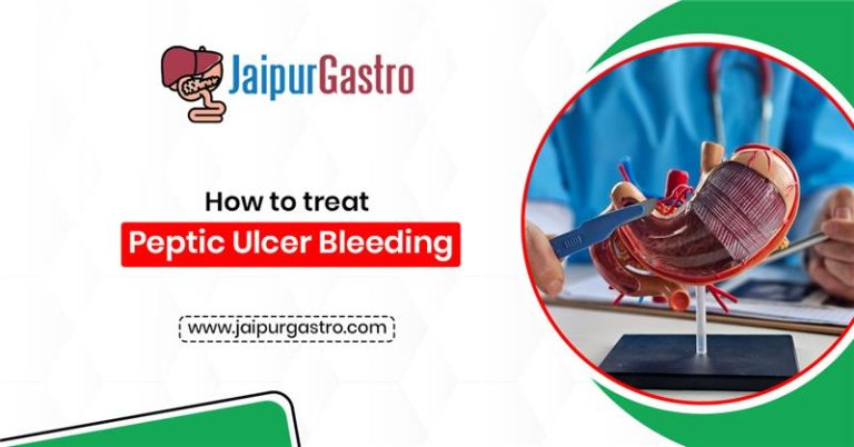 How to Treat Peptic Ulcer Bleeding | Jaipur Gastro