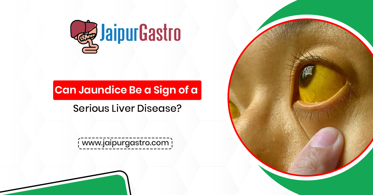 Is Jaundice a Sign of a Serious Liver Disease? Expert Guide Jaipur
